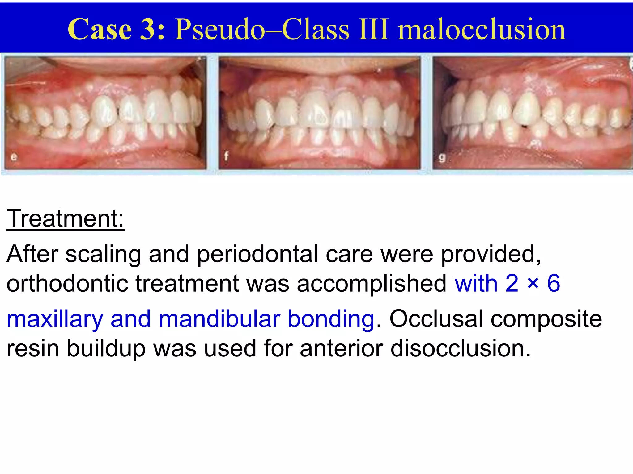 Anterior dental crossbite and class iii malocclusion1 | PPTX