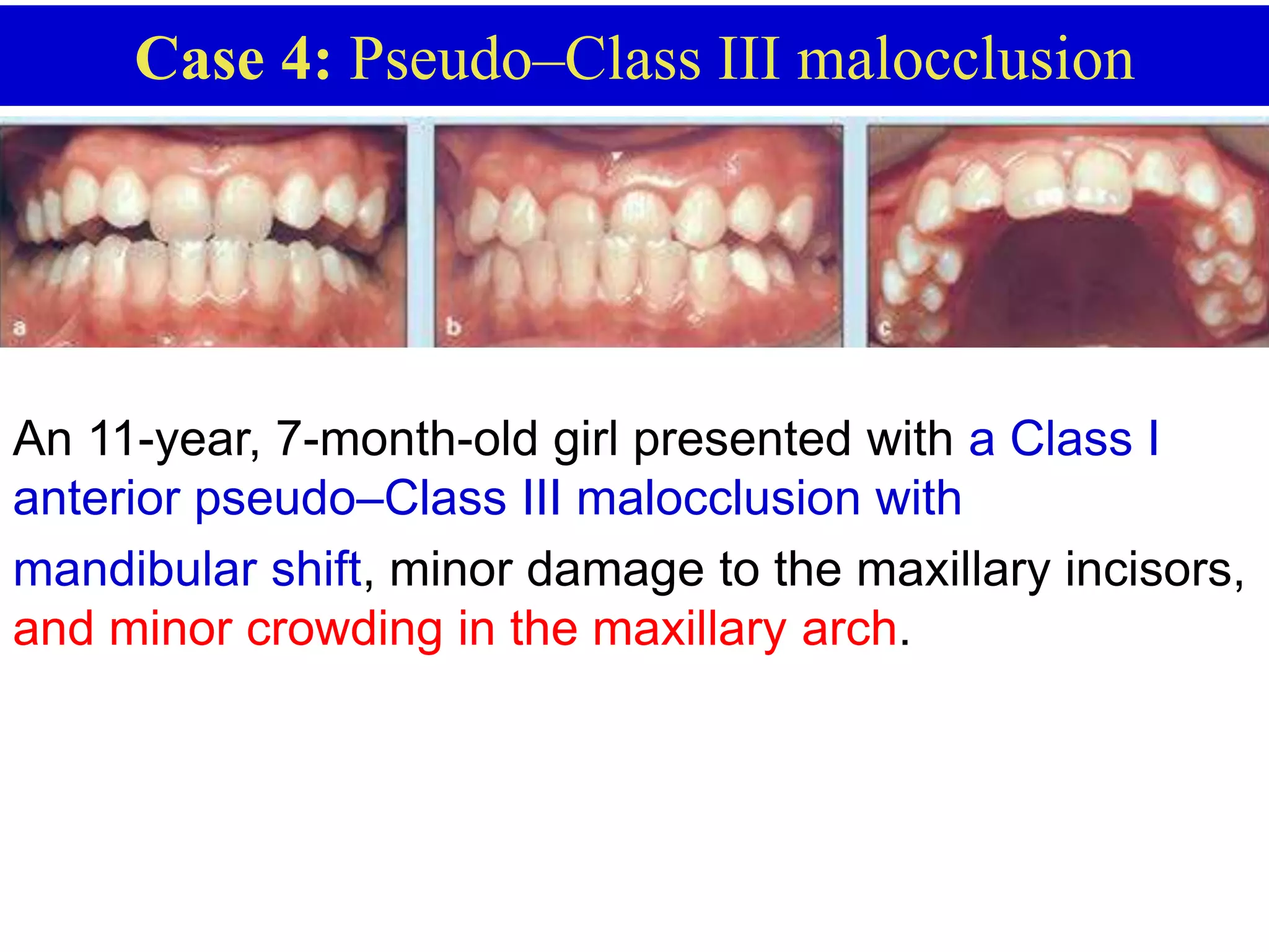 Anterior dental crossbite and class iii malocclusion1 | PPTX