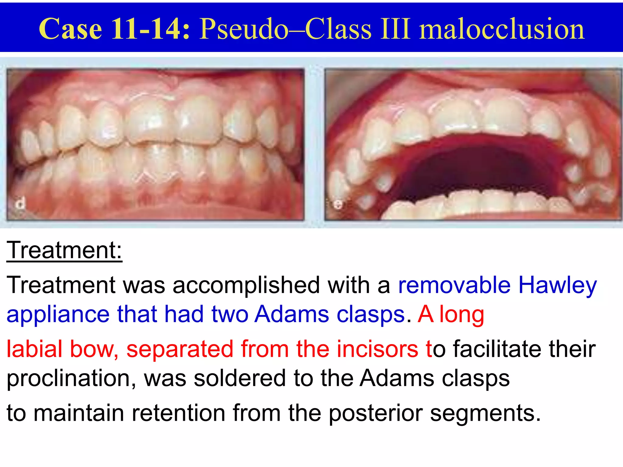 Anterior dental crossbite and class iii malocclusion1 | PPTX