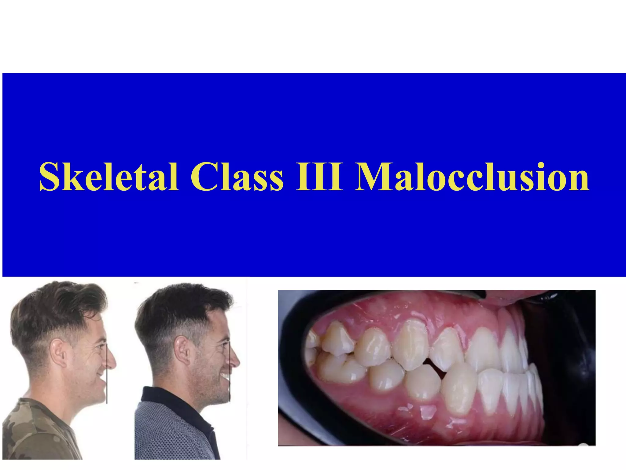 Anterior dental crossbite and class iii malocclusion1 | PPTX