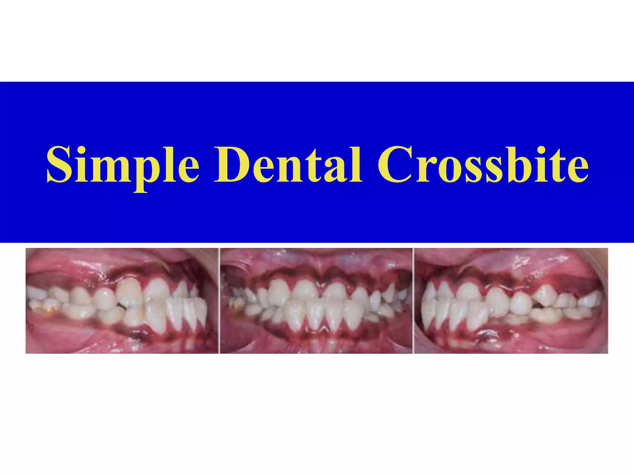 Anterior dental crossbite and class iii malocclusion1 | PPTX