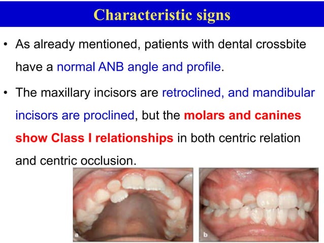 Anterior dental crossbite and class iii malocclusion1 | PPTX