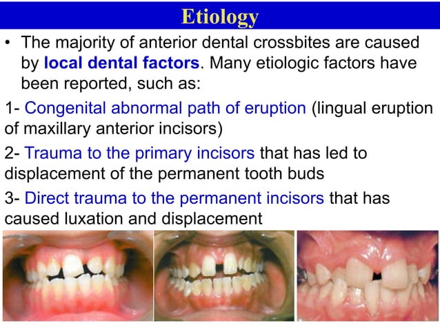 Anterior dental crossbite and class iii malocclusion1 | PPTX