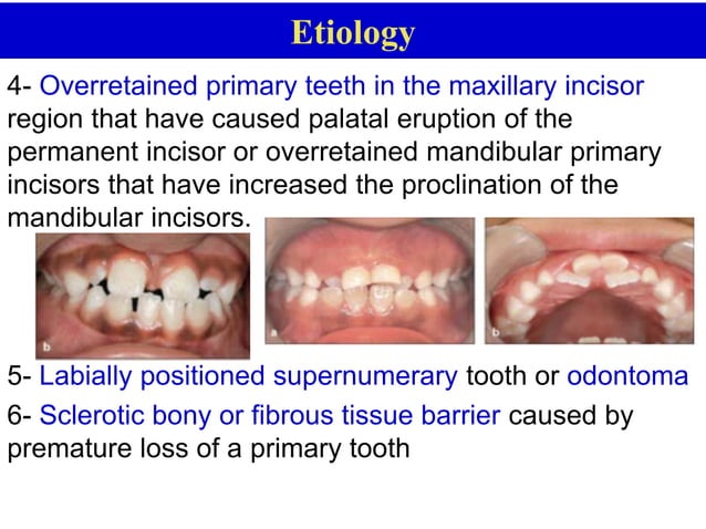 Anterior dental crossbite and class iii malocclusion1 | PPTX