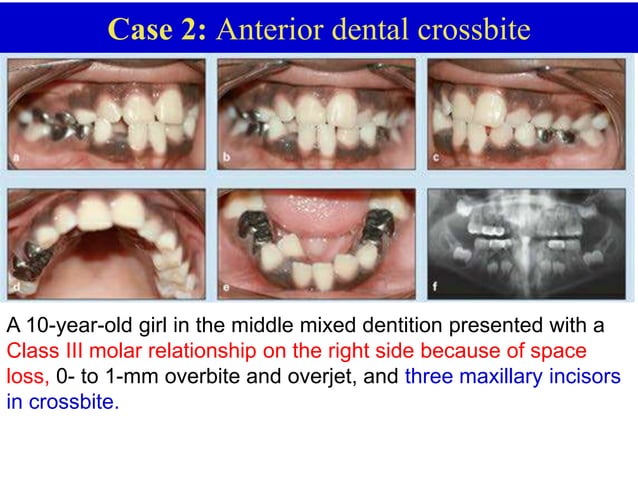 Anterior dental crossbite and class iii malocclusion1 | PPTX