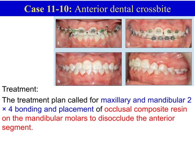 Anterior dental crossbite and class iii malocclusion1 | PPTX
