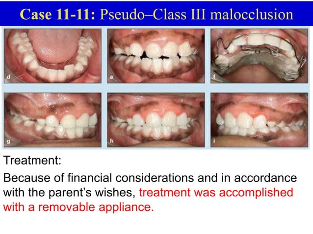 Anterior dental crossbite and class iii malocclusion1 | PPTX