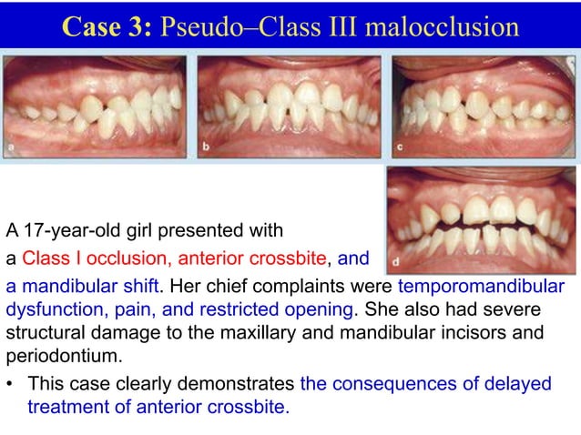 Anterior dental crossbite and class iii malocclusion1 | PPTX