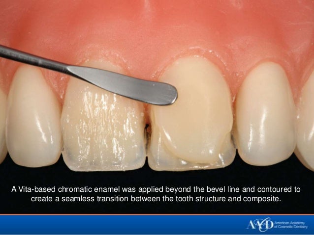 Anterior Direct Restorations
