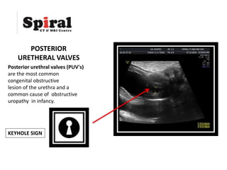 Anterior ectopic anus advanced usg lounge | PPTX
