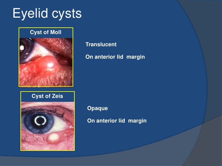 Anterior eye structures disorders