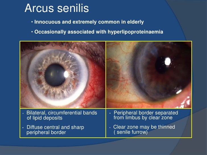 Anterior eye structures disorders