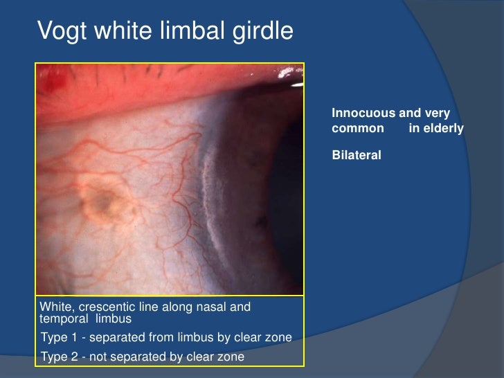 Anterior eye structures disorders