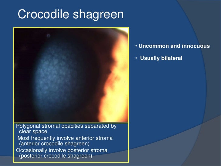 Anterior eye structures disorders