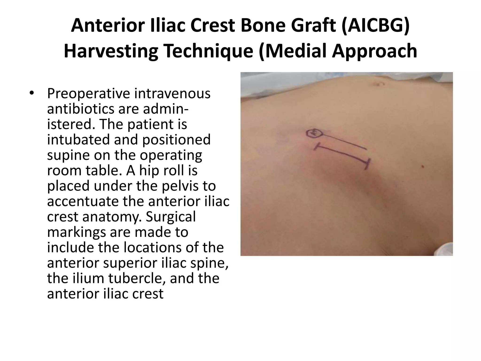 Anterior iliac crest | PPTX
