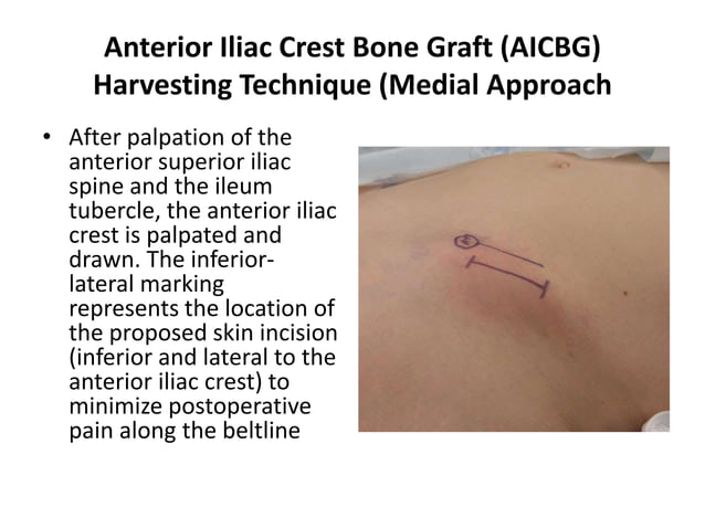 Anterior iliac crest | PPT