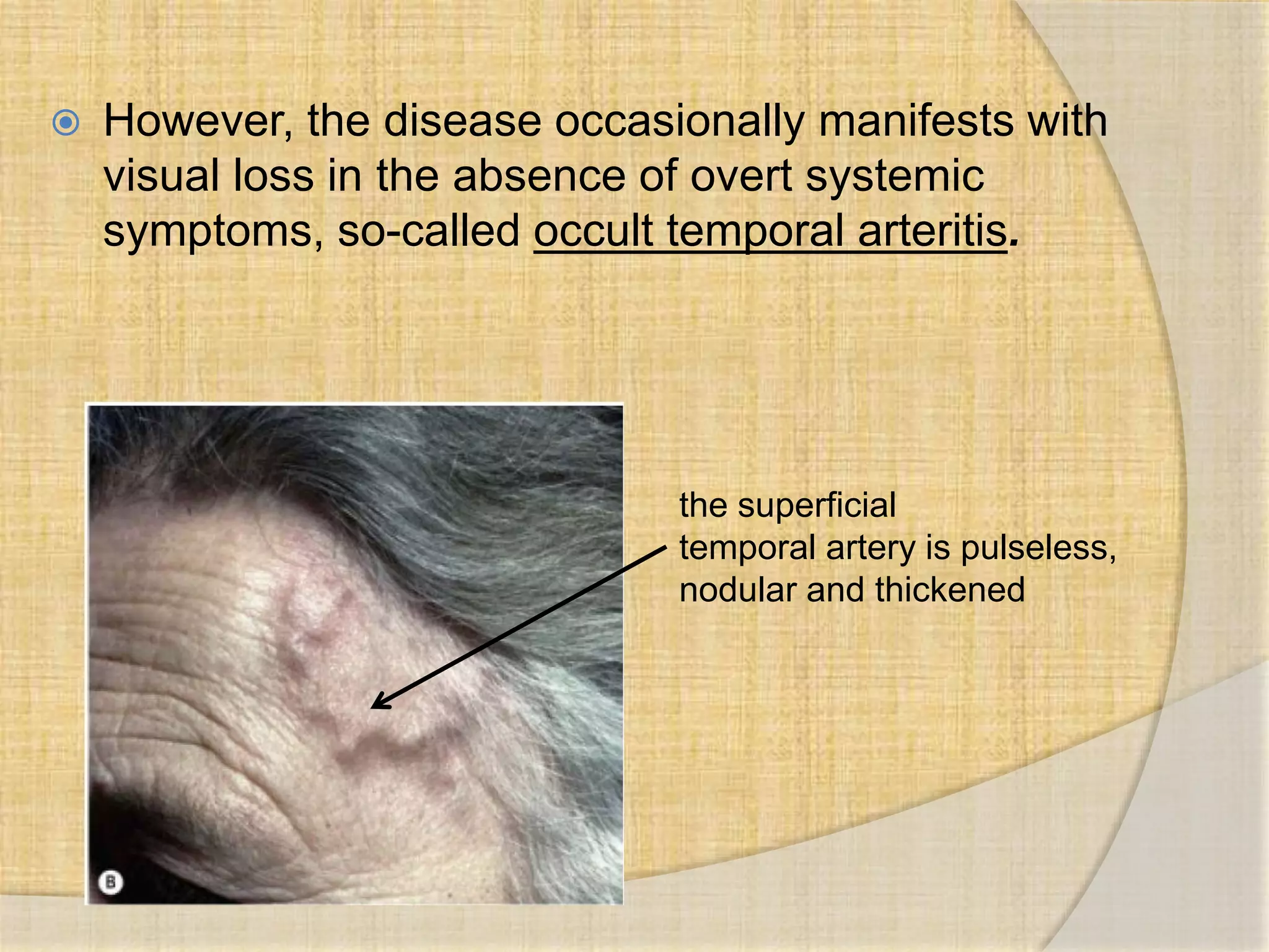 Anterior ischemic optic neuropathy | PPTX
