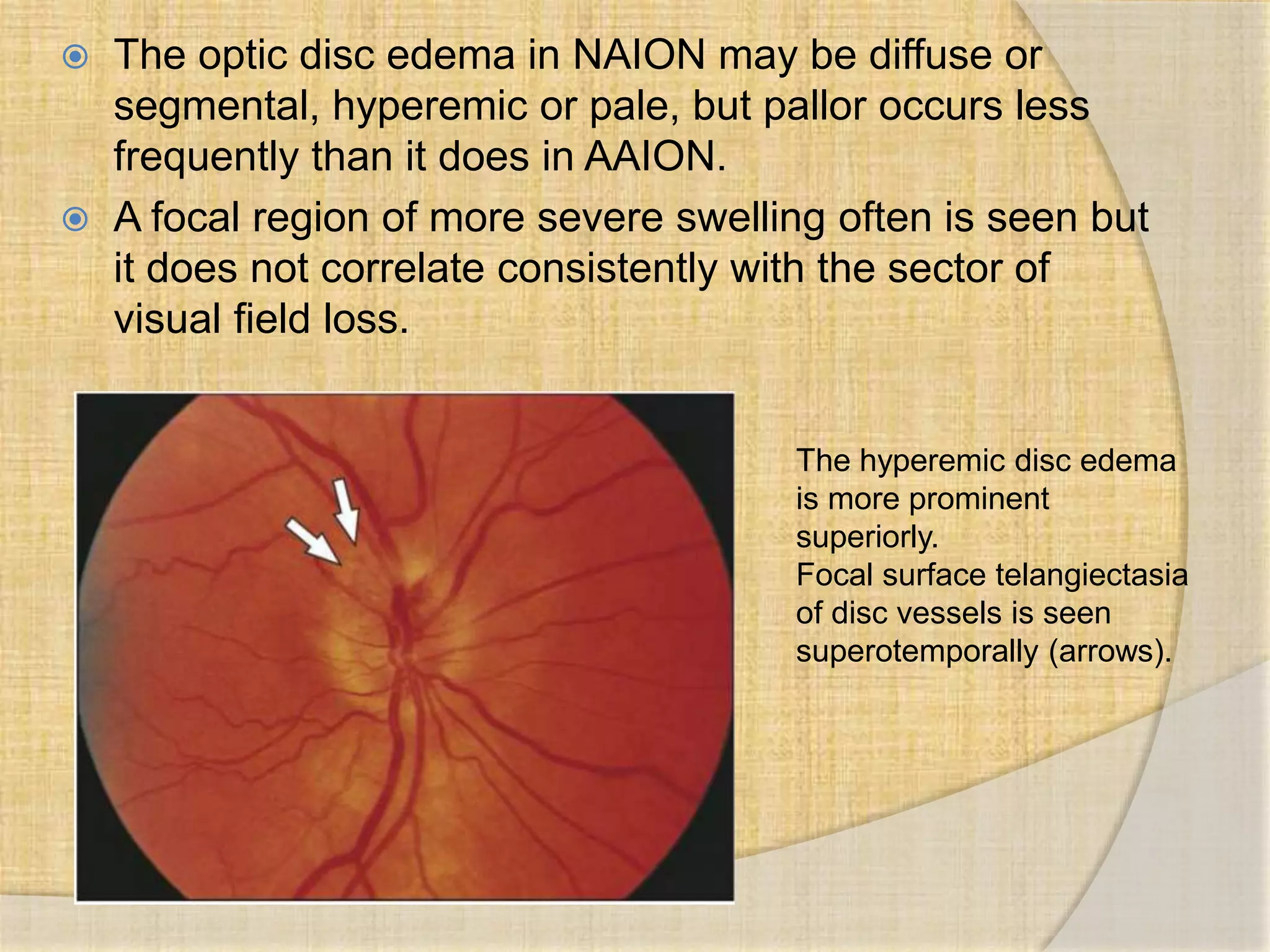 Anterior ischemic optic neuropathy | PPTX