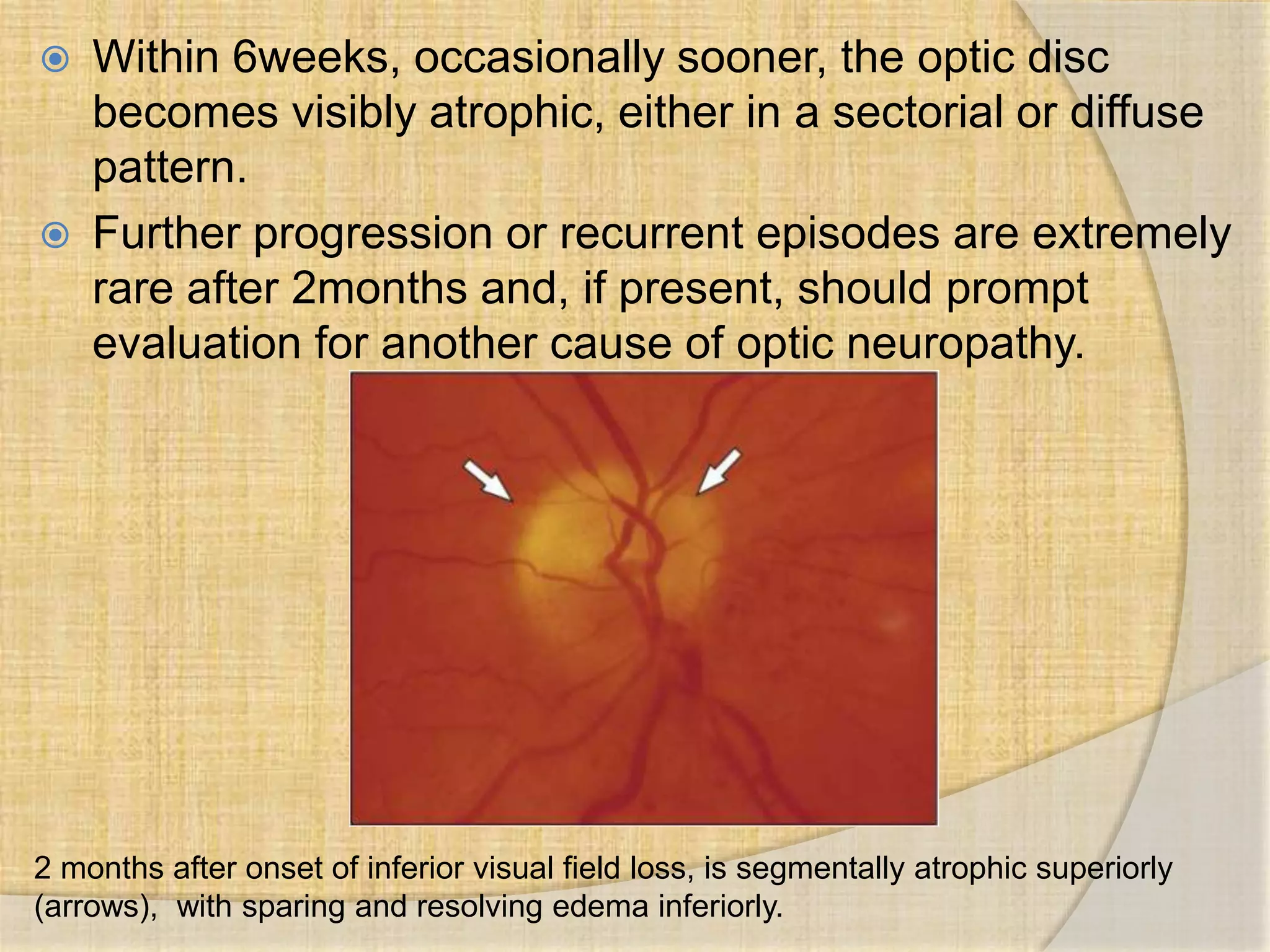 Anterior ischemic optic neuropathy | PPTX