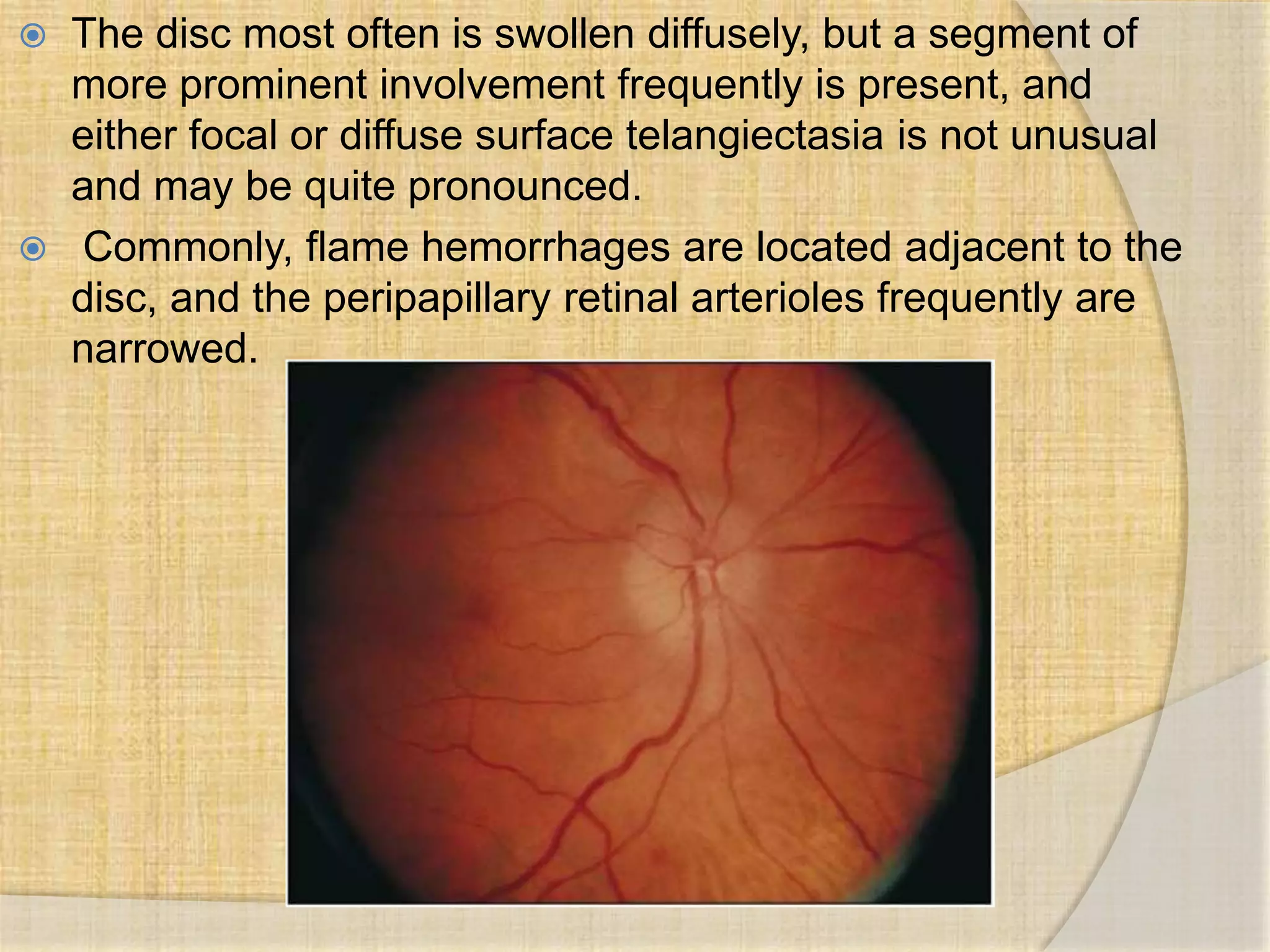 Anterior ischemic optic neuropathy | PPTX