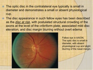 Anterior ischemic optic neuropathy | PPTX