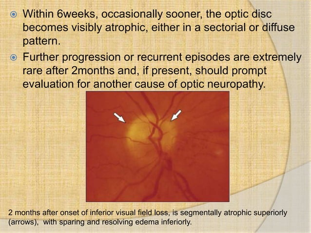 Anterior ischemic optic neuropathy | PPTX