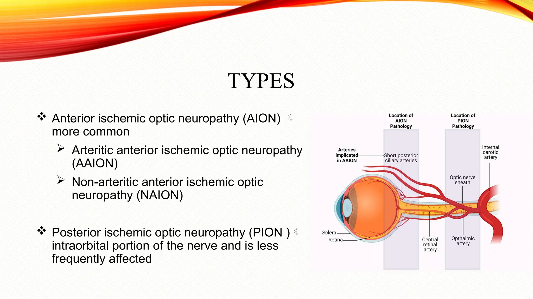 Anterior ischemic optic neuropathy.pptx