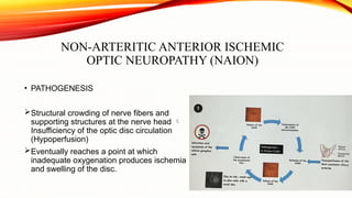 Anterior ischemic optic neuropathy.pptx