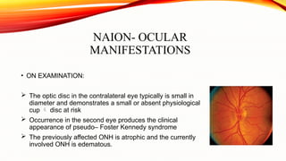 Anterior ischemic optic neuropathy.pptx