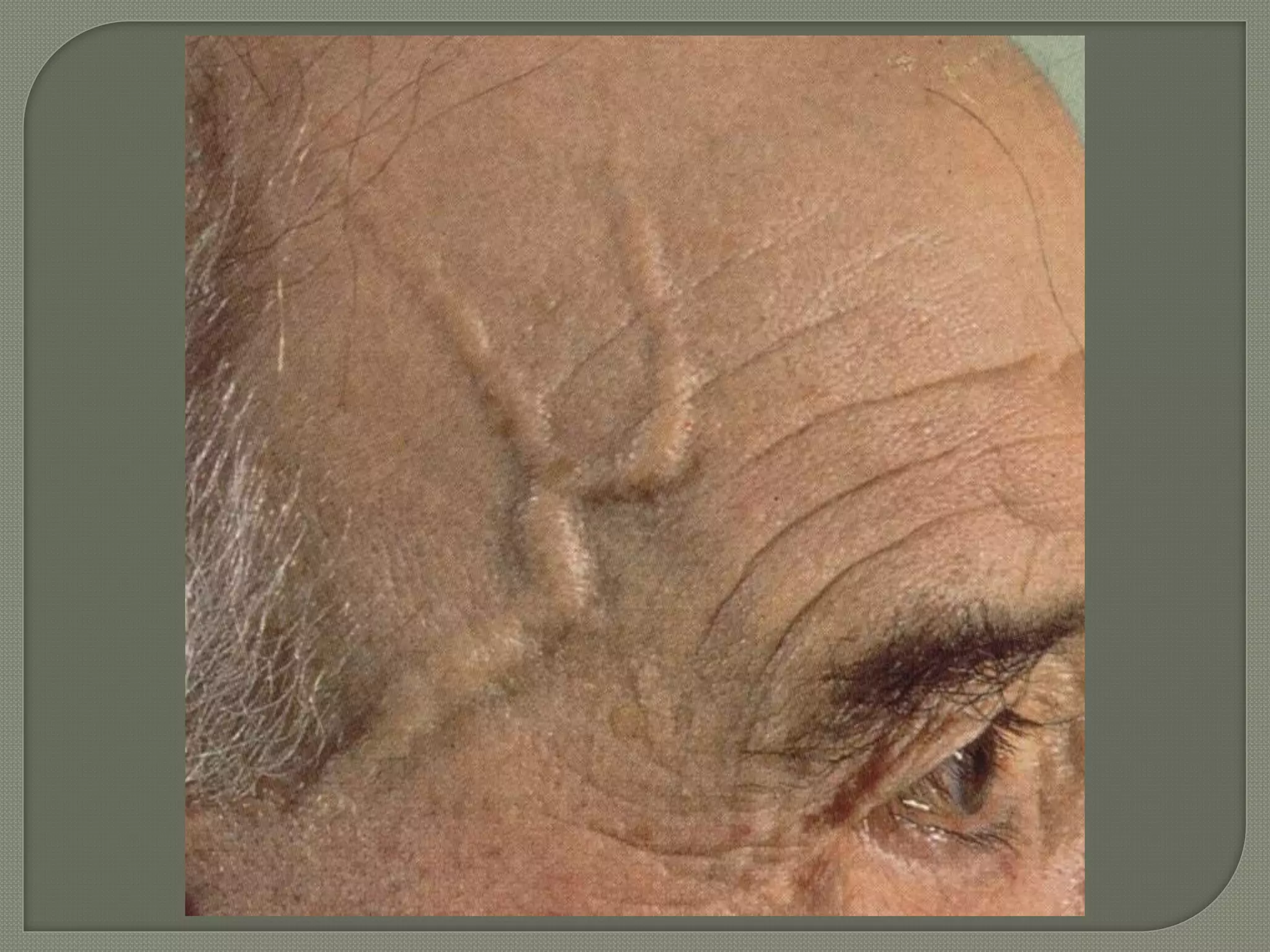 Anterior ischemic optic neuropathy (AION).pptx | Eye and Vision ...