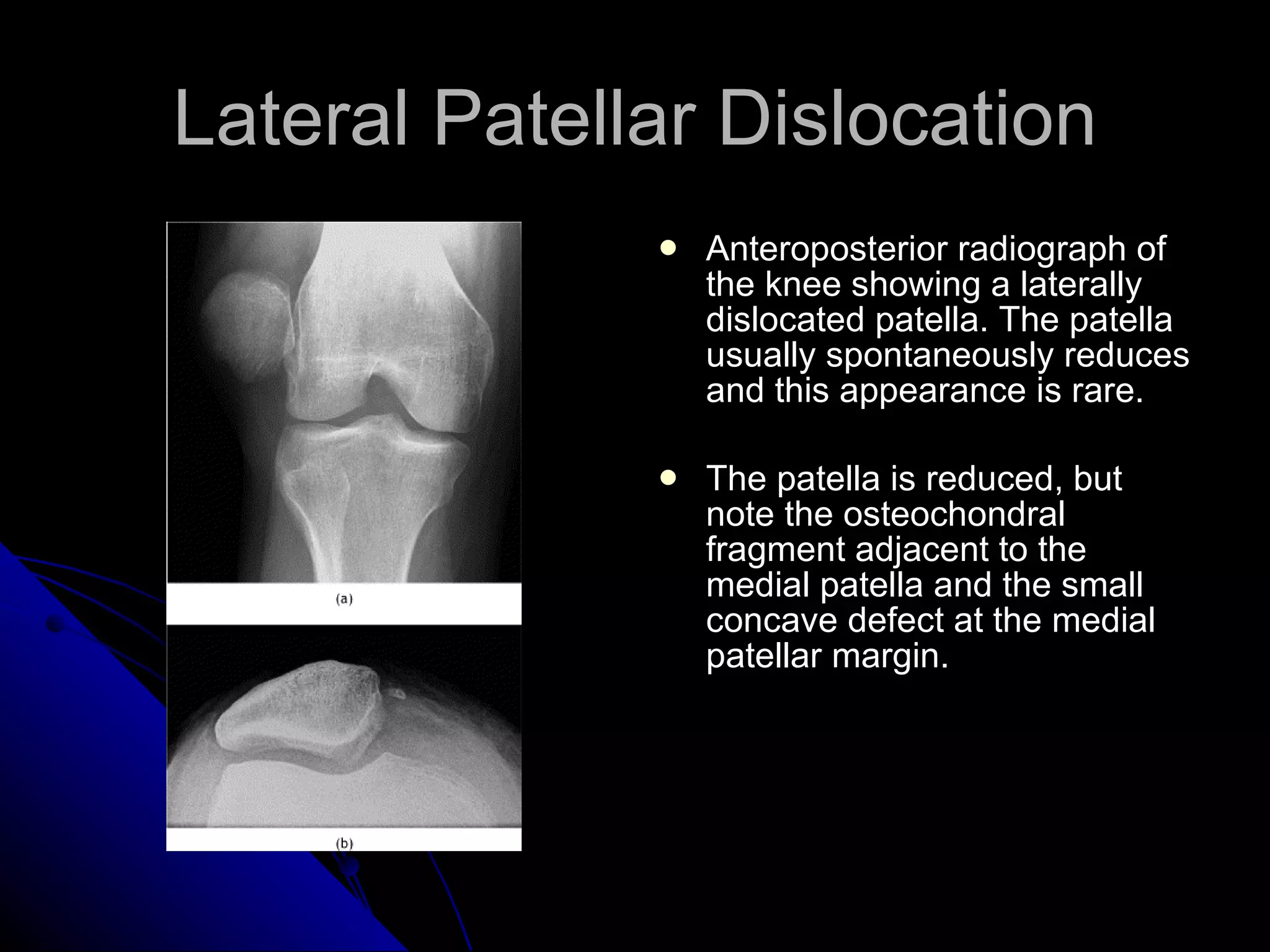Anterior knee pain | PPT