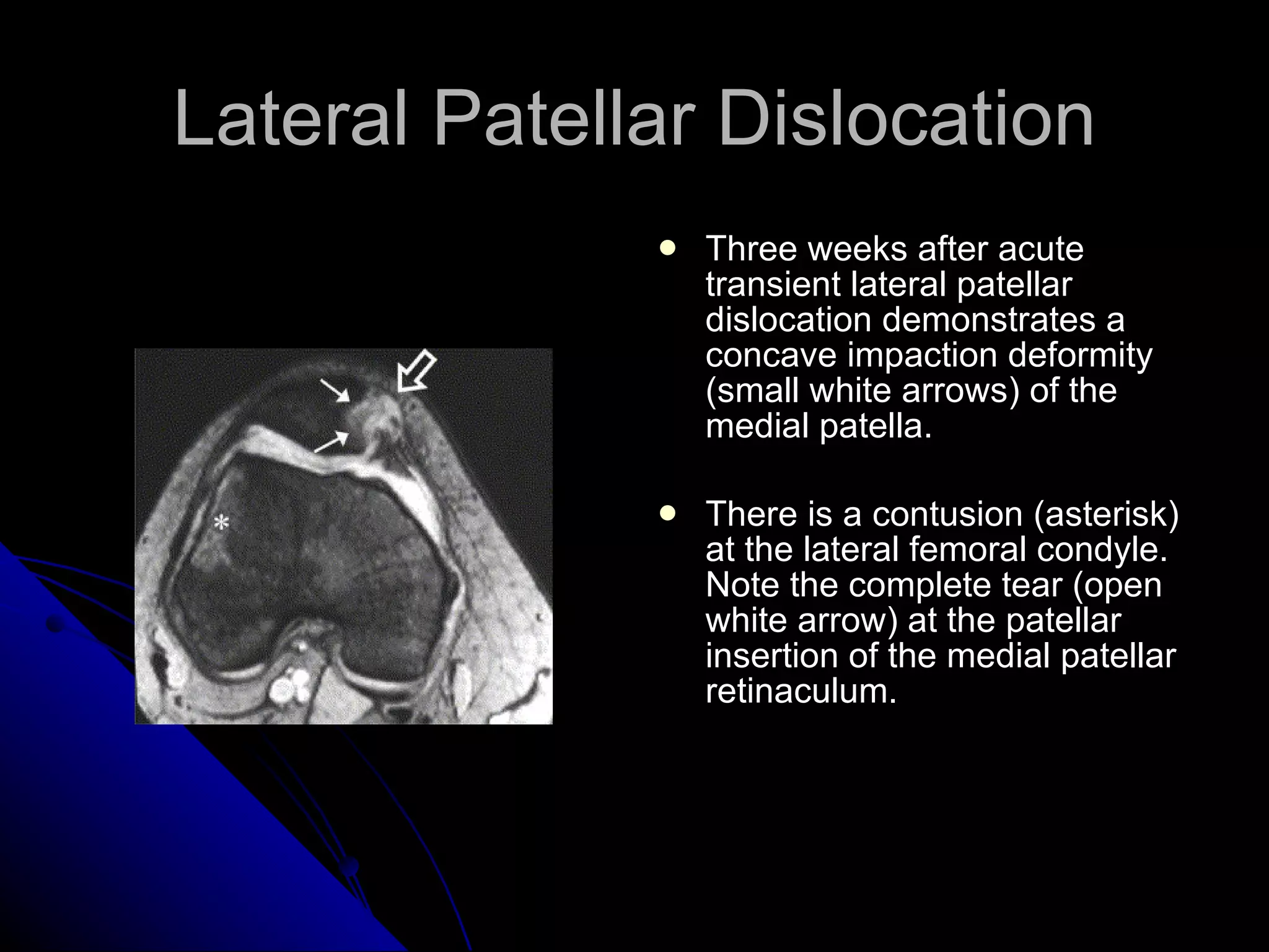 Anterior knee pain | PPT