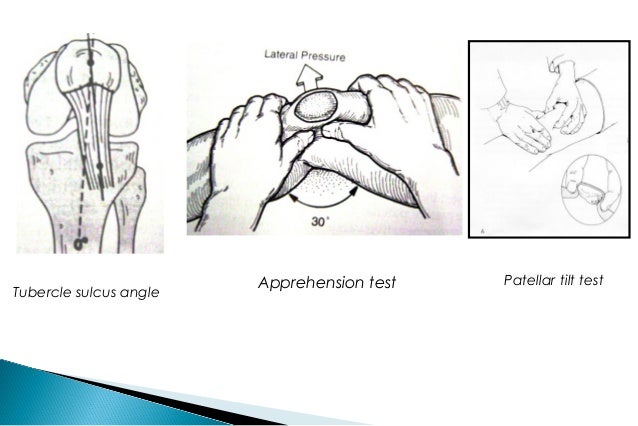Anterior knee pain