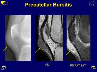 Anterior Knee Pain By Dr. Brian Sabb | PPT