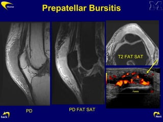 Anterior Knee Pain By Dr. Brian Sabb | PPT