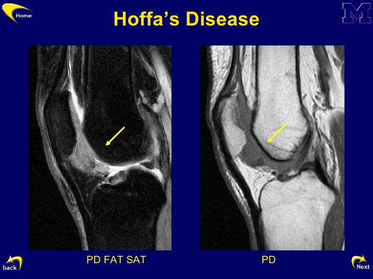 Anterior Knee Pain By Dr. Brian Sabb