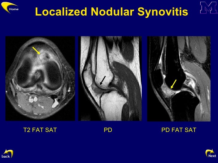 Anterior Knee Pain By Dr. Brian Sabb