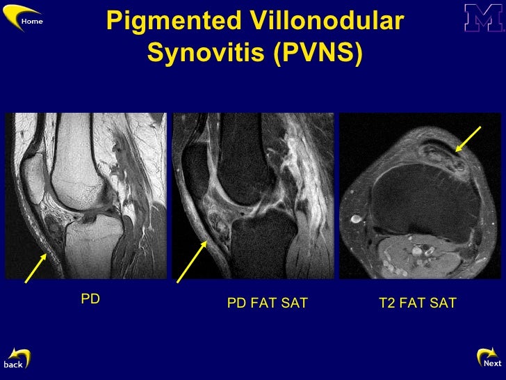 Anterior Knee Pain By Dr. Brian Sabb