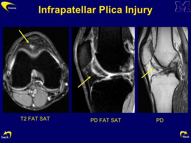 Anterior Knee Pain By Dr. Brian Sabb