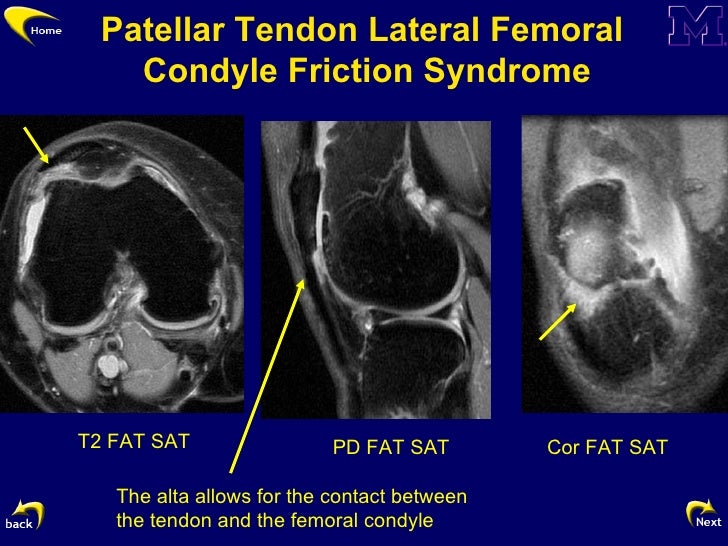 Anterior Knee Pain By Dr. Brian Sabb