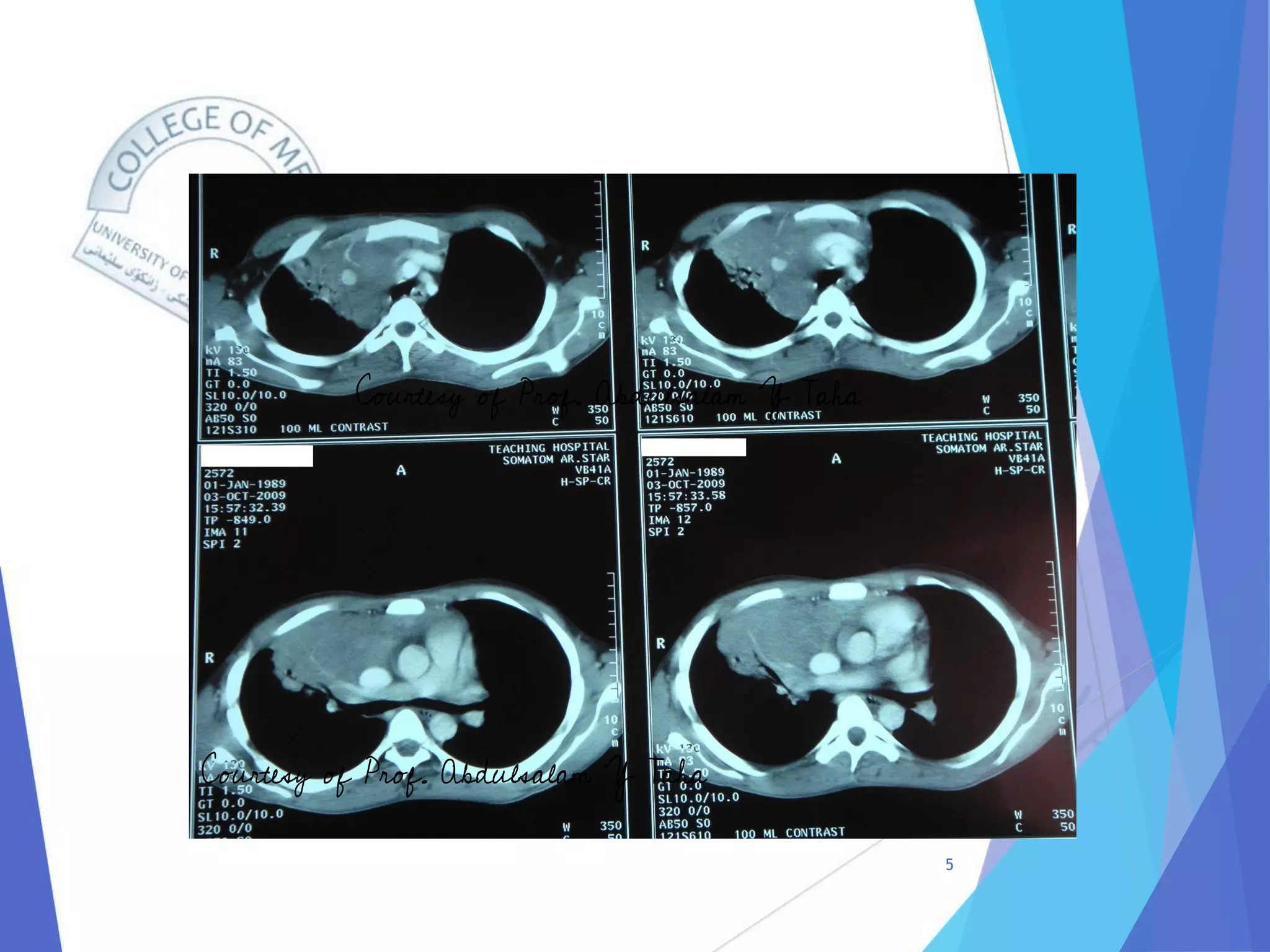 Anterior Mediastinotomy for Anterior Mediastinal Mass.pdf