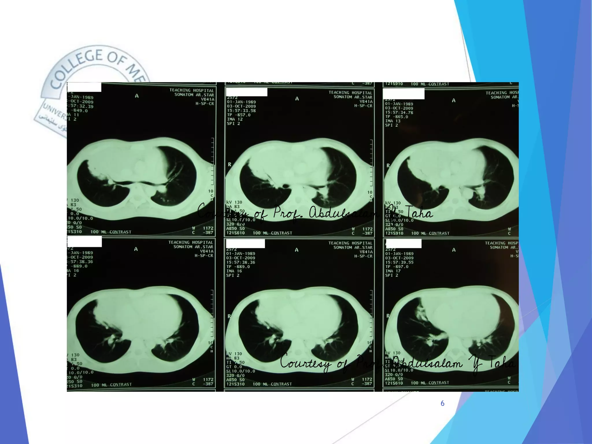 Anterior Mediastinotomy for Anterior Mediastinal Mass.pdf