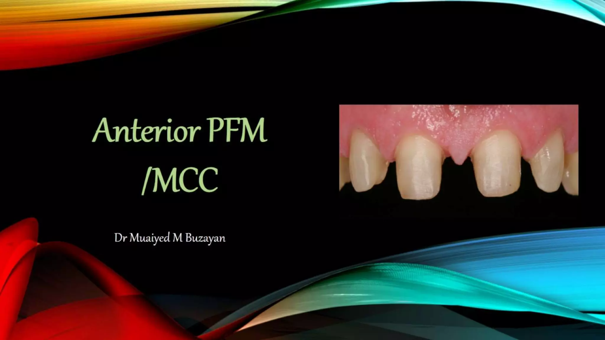 Anterior metal ceramic crown pfm | PPTX