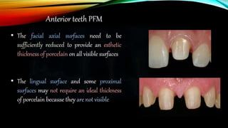 Anterior metal ceramic crown pfm | PPT