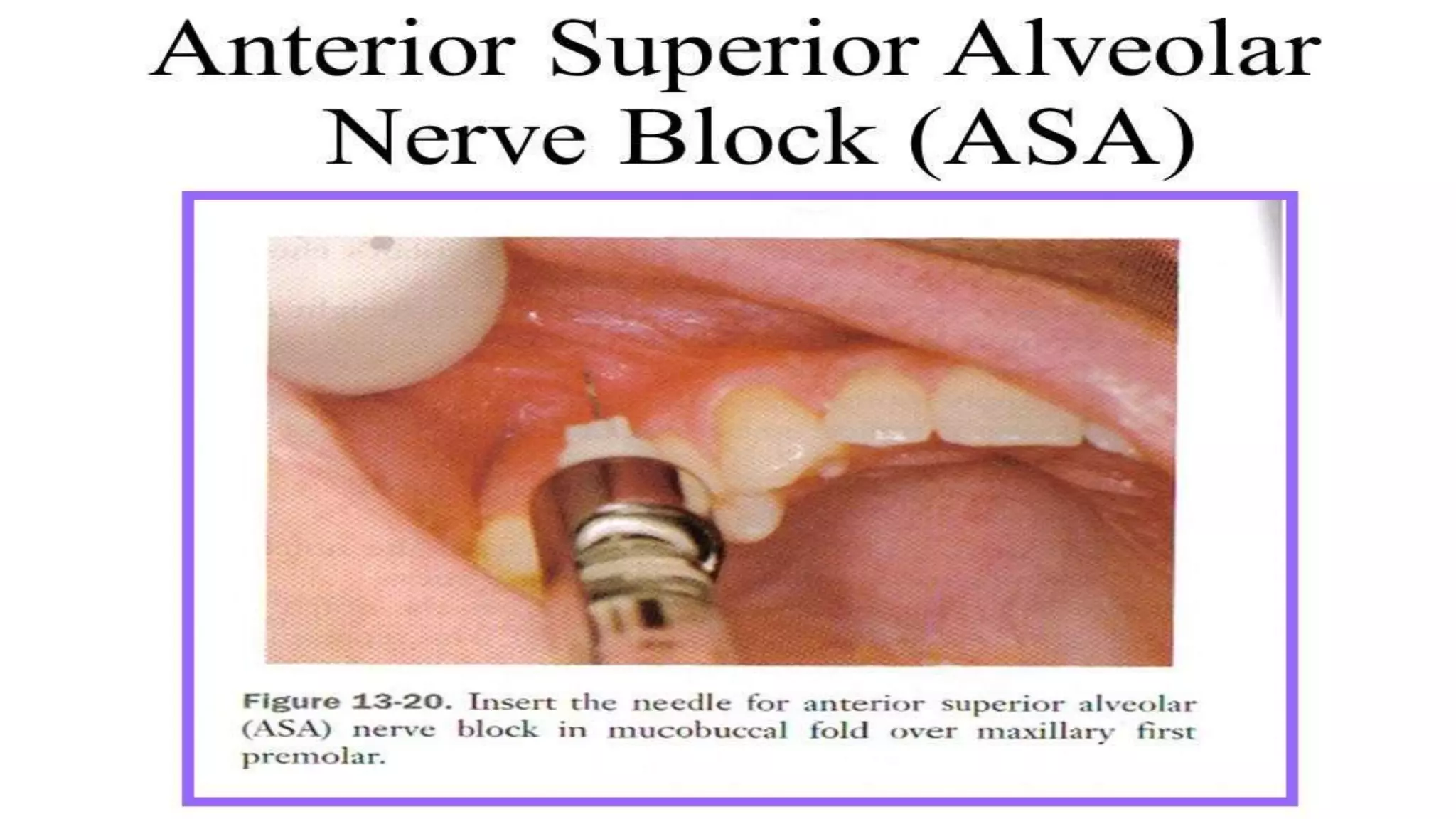 Anterior middle superior alveolar nerve | PPTX