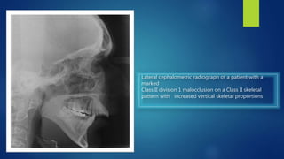 Anterior open bite aetiology and its management | PPTX