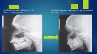 Anterior open bite aetiology and its management | PPTX
