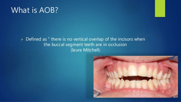 Anterior open bite aetiology and its management