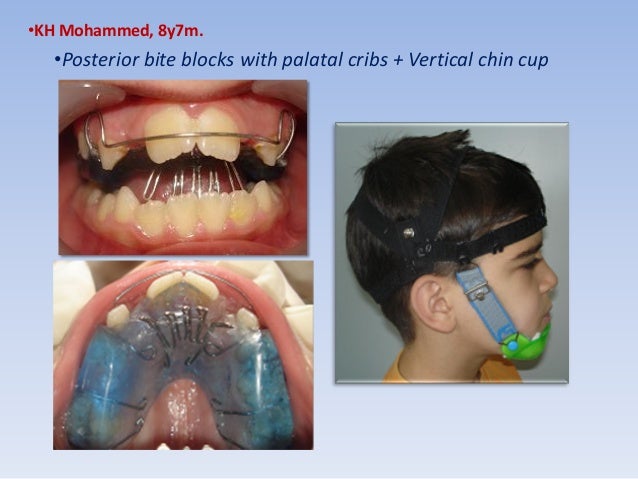 Anterior open bite treatment deciduous and mixed dentition .slide