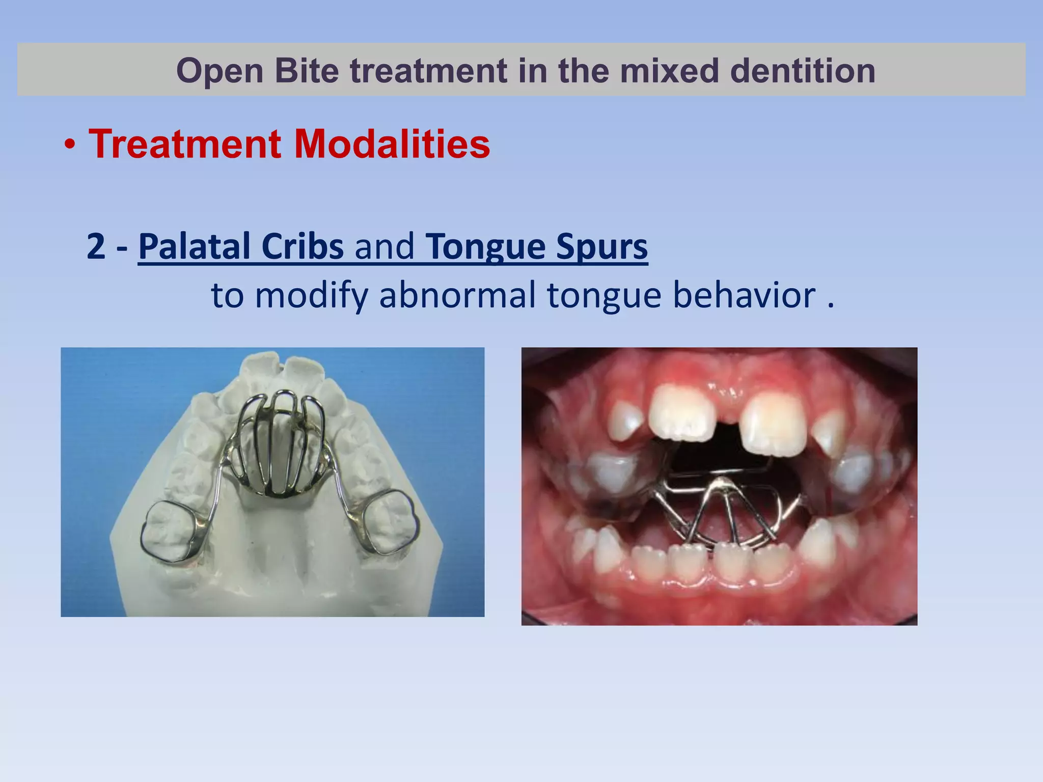 Anterior open bite treatment deciduous and mixed dentition .slide | PDF